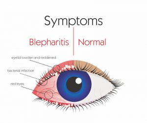 Ophthalmogen: Η ΛΥΣΗ ΣΤΗ ΒΛΕΦΑΡΙΤΙΔΑ, ΞΗΡΟΦΘΑΛΜΙΑ, ΠΡΗΣΜΕΝΑ ...